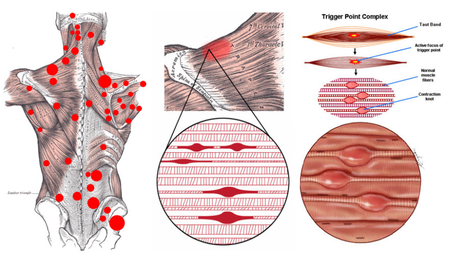 trigger-point – นายโชค ดอทคอม 9CHOKE.COM